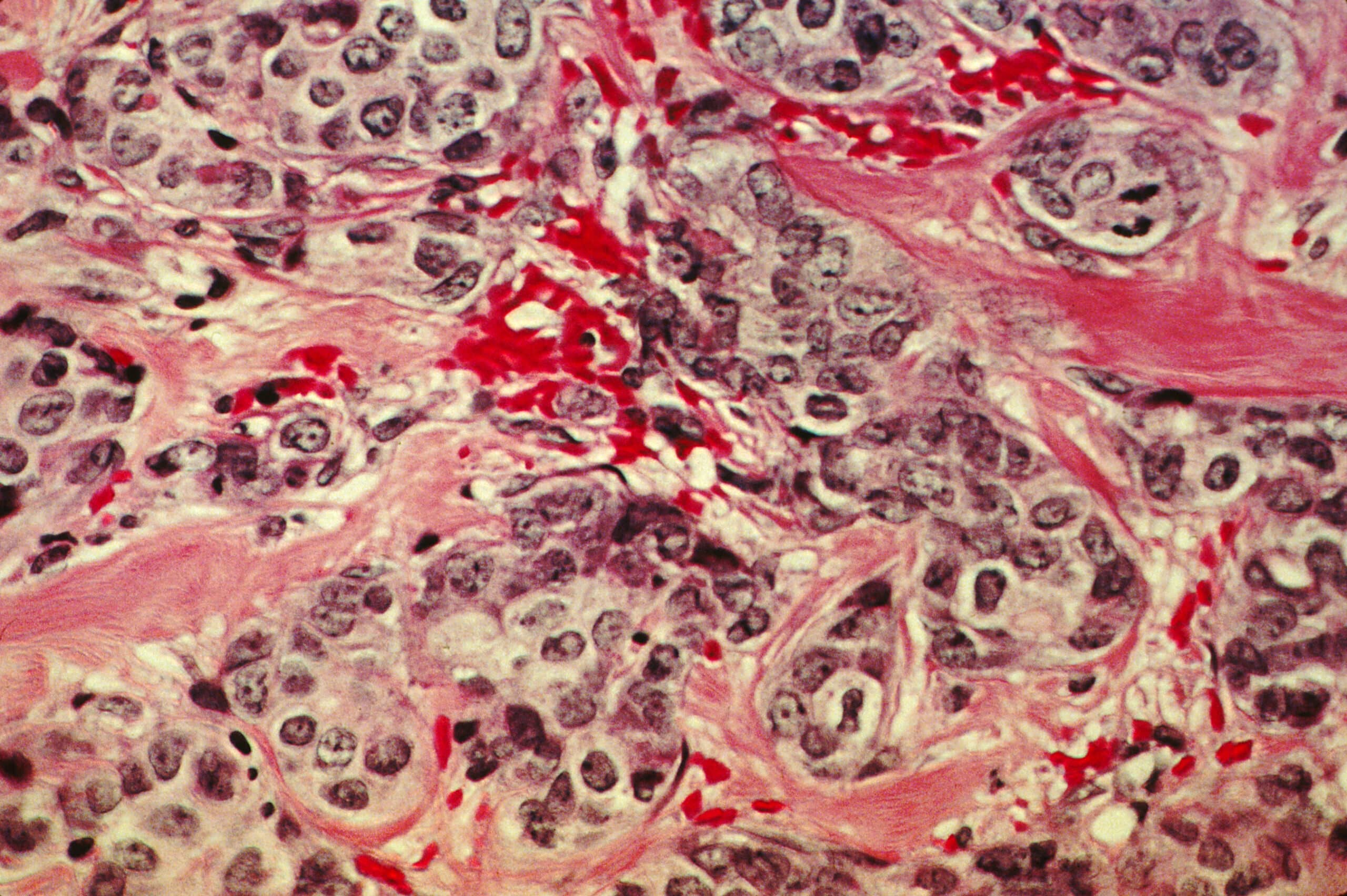 Discovery Institute-Funded Paper Applies ID Approach to Cancer ...